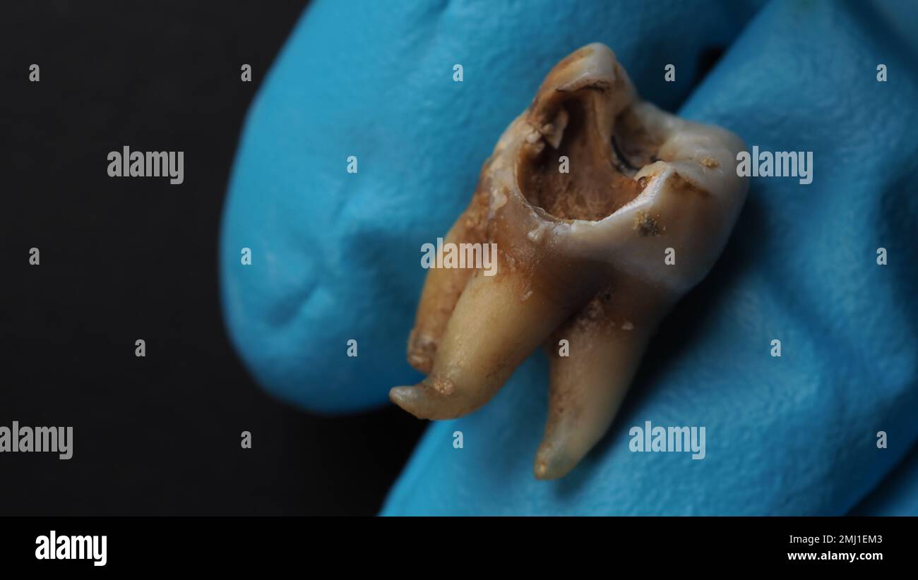 Tooth decay and dentist hand with glove and black background. Macro ...