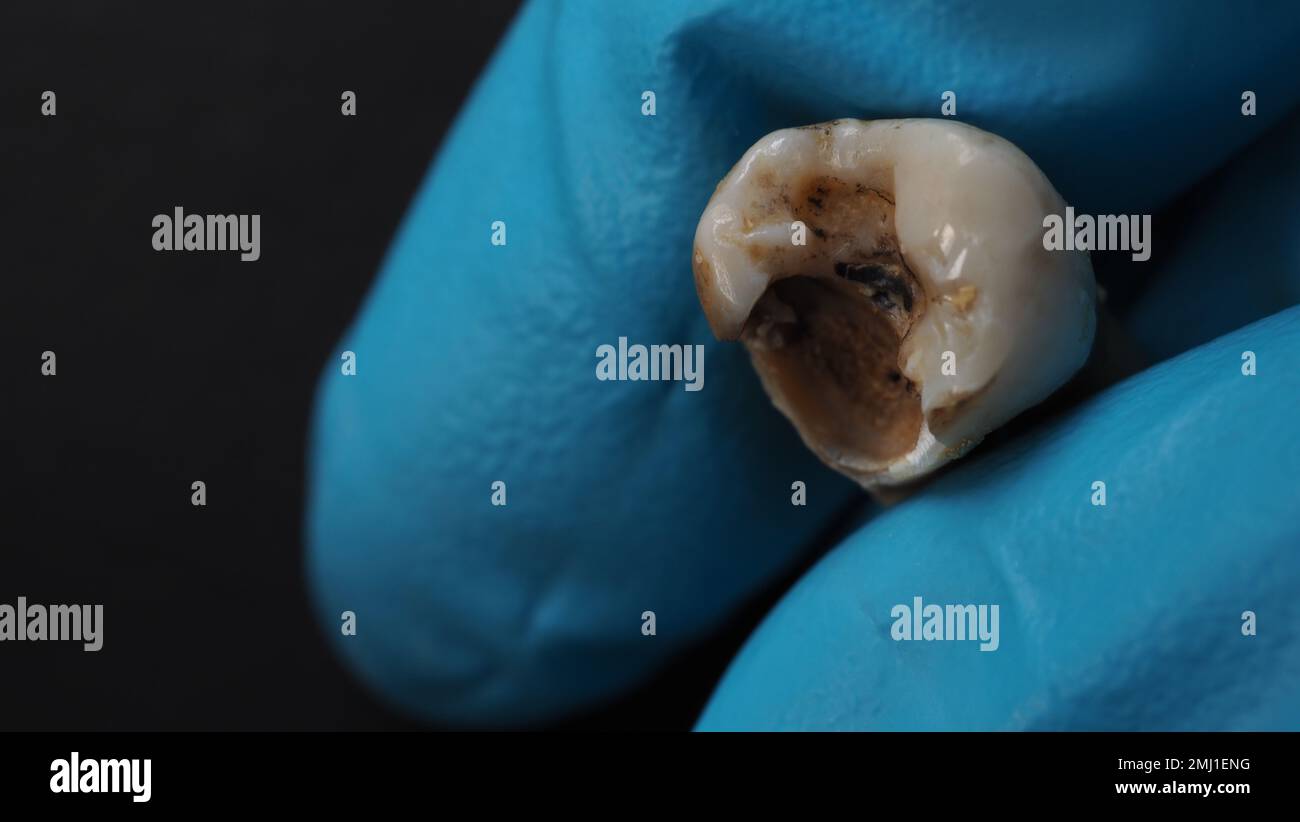 Tooth decay and dentist hand with glove and black background. Macro ...