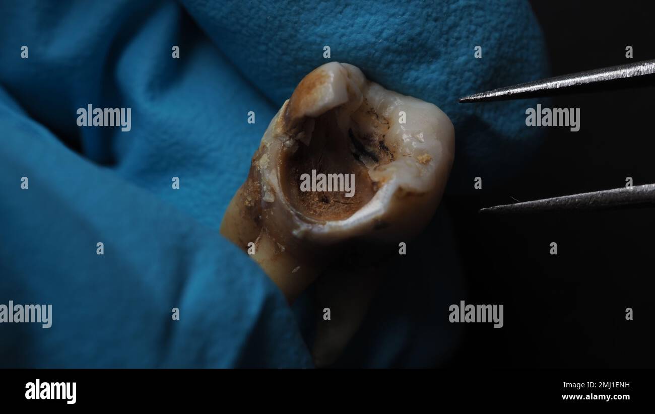 Tooth decay and dentist hand with glove and black background. Macro ...