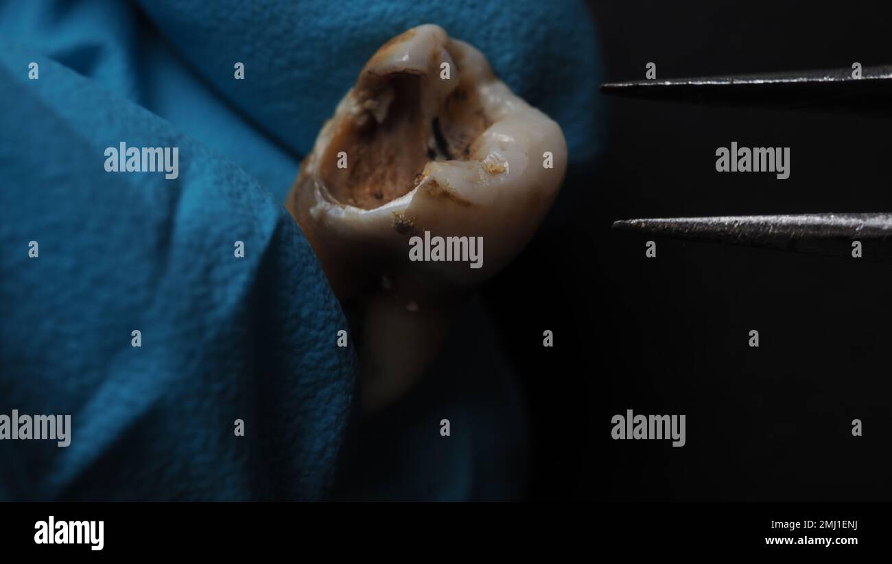 Tooth decay and dentist hand with glove and black background. Macro ...