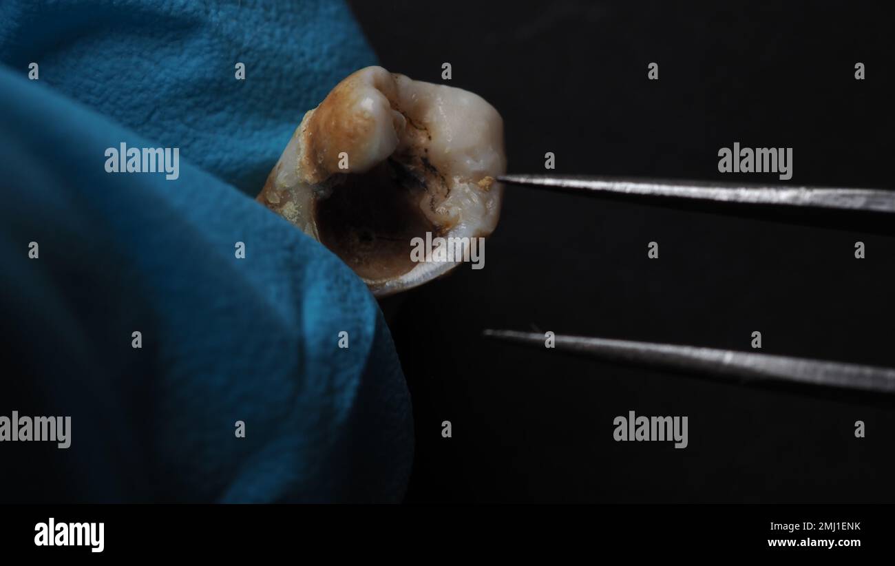 Tooth decay and dentist hand with glove and black background. Macro ...