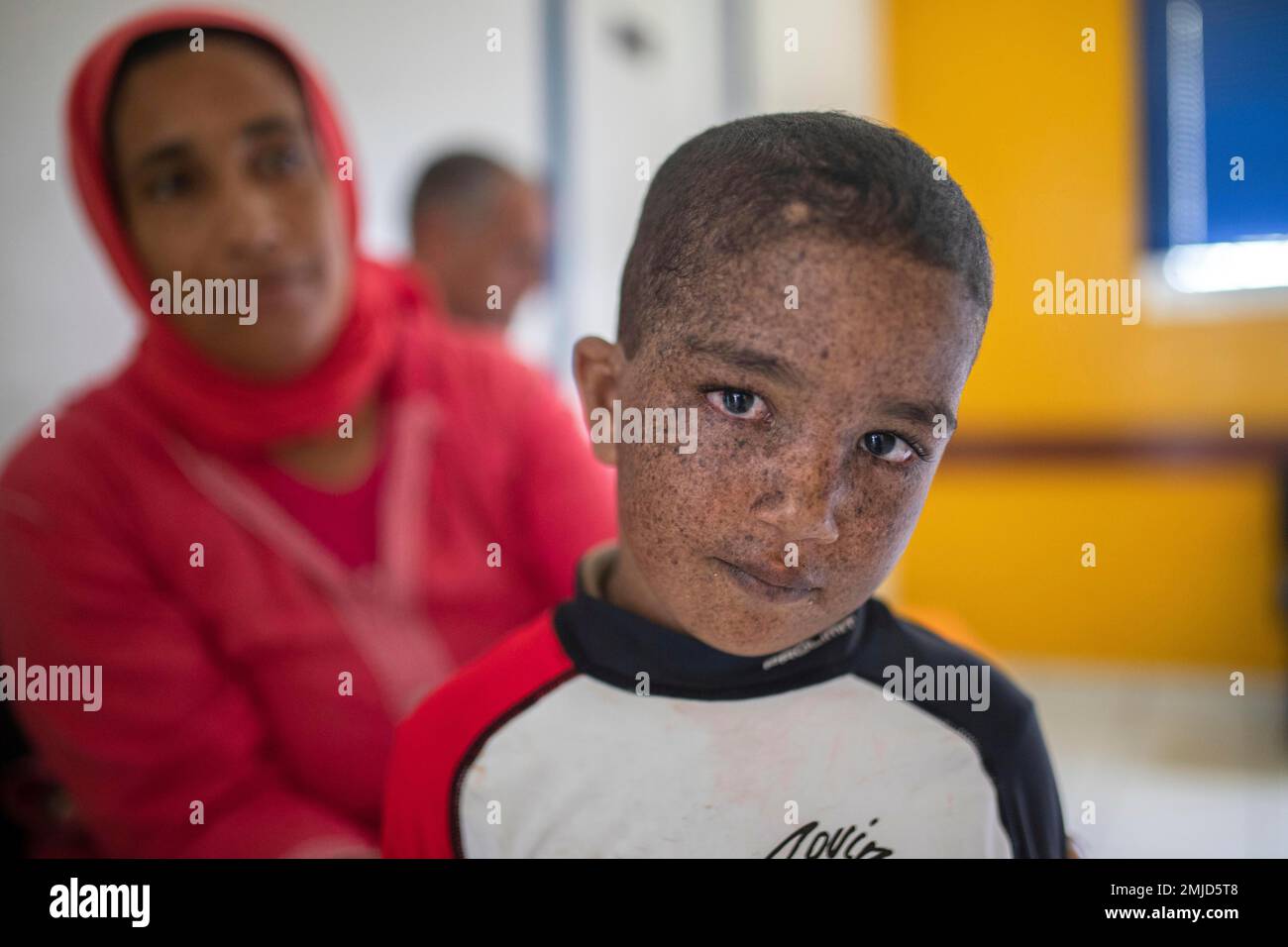 Xeroderma Pigmentosum Pictures Symptoms Treatment And More