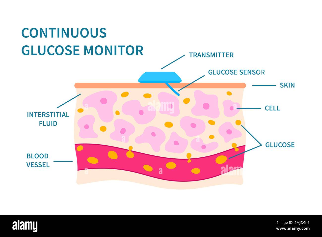 Continuous glucose monitor, illustration Stock Photo - Alamy Continuous glucose monitor, illustration Stock Photo - Alamy