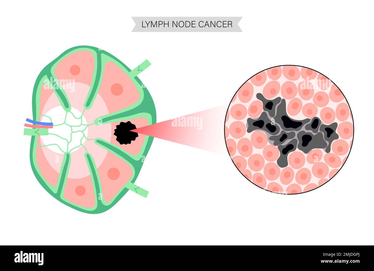 Lymphoma, conceptual illustration Stock Photo - Alamy