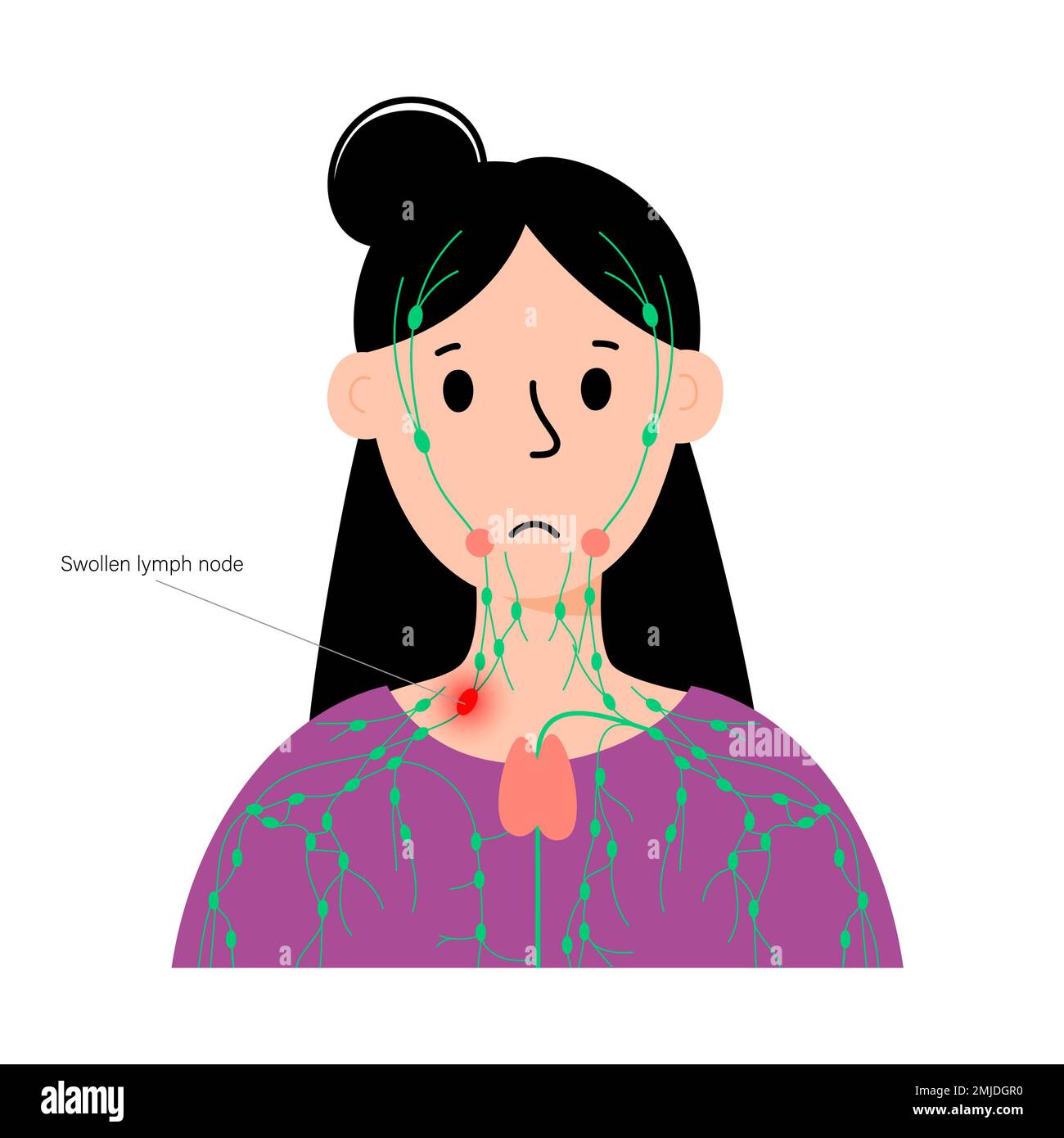 Tonsillar Lymph Node Swollen Tonsillar Lymph Node Swollen