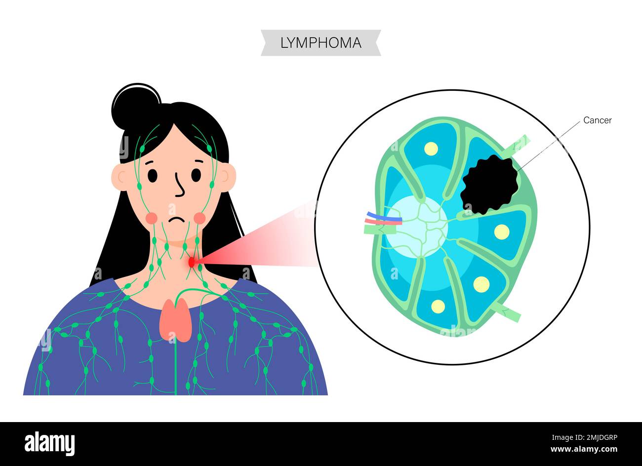 Lymphoma Cancer Neck