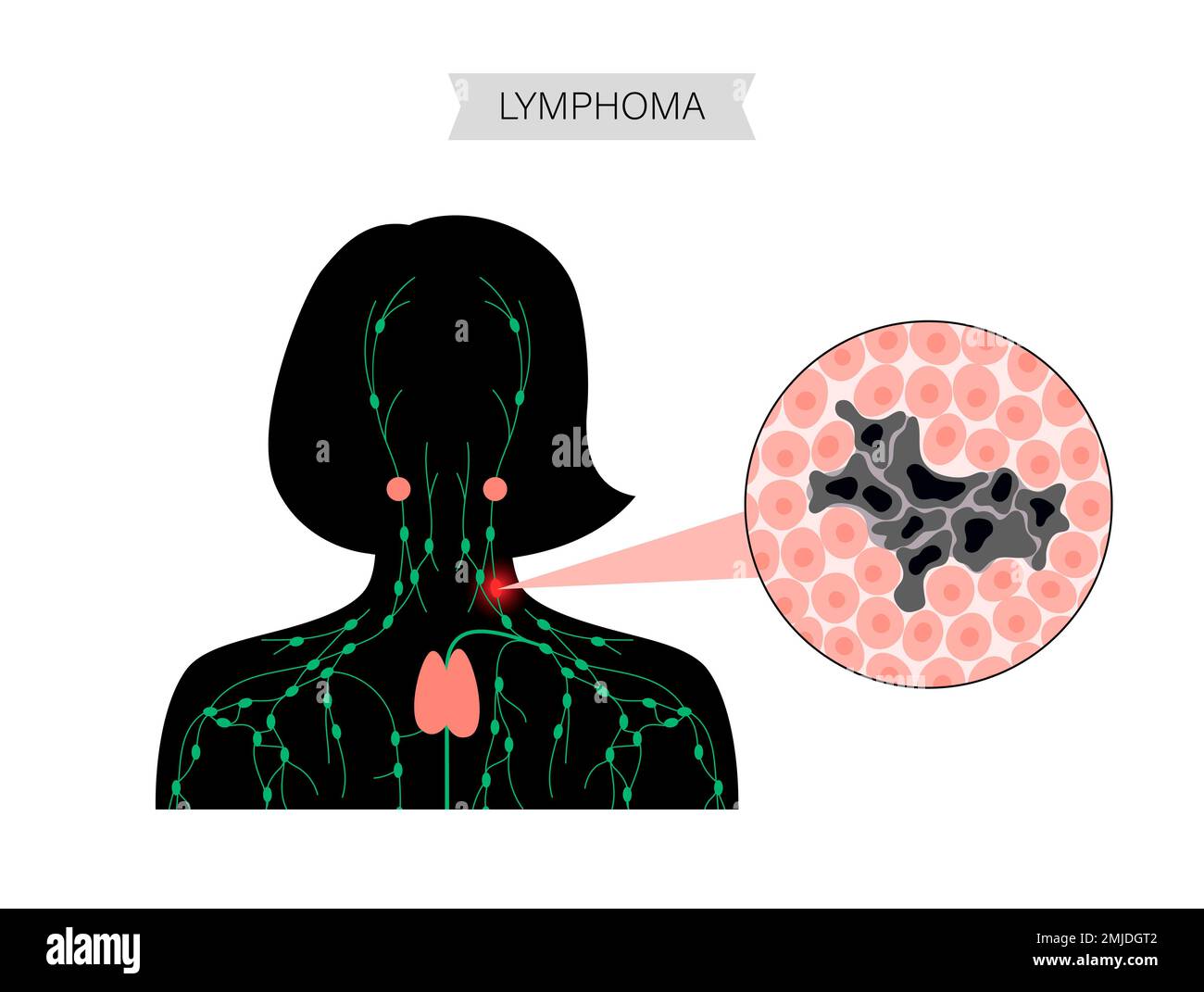 Swollen lymph nodes neck hi-res stock photography and images - Alamy