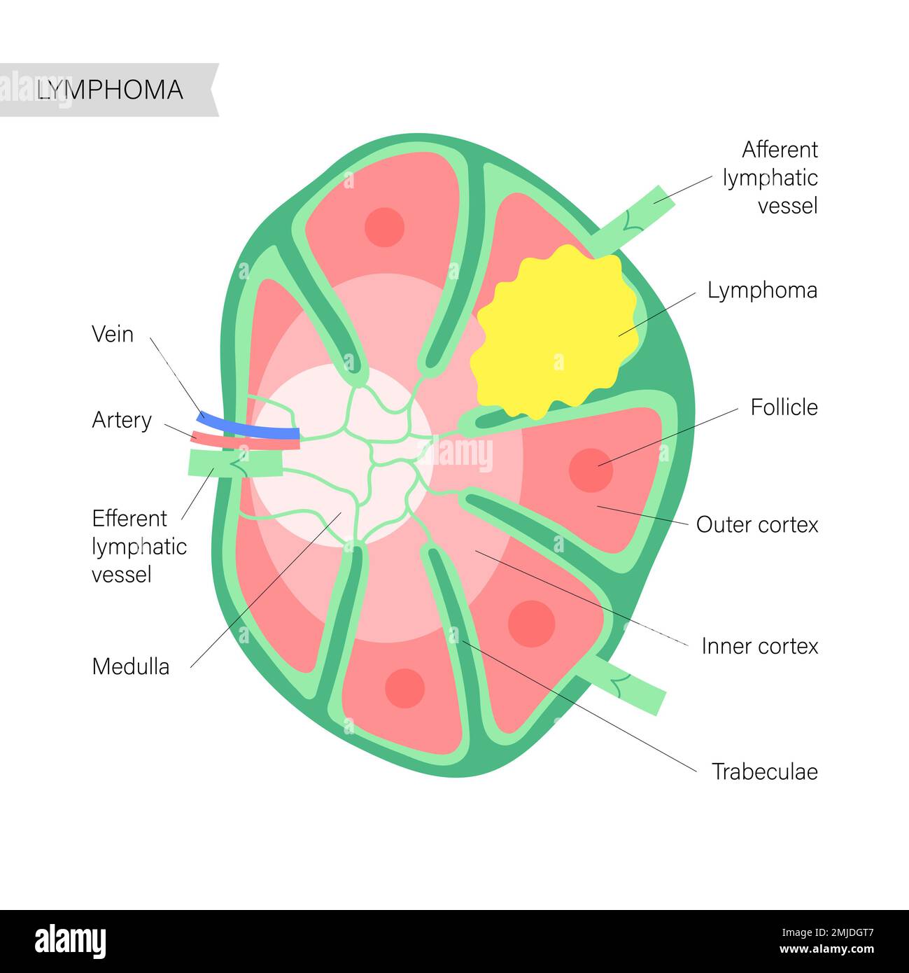 Lymphoma, conceptual illustration Stock Photo - Alamy