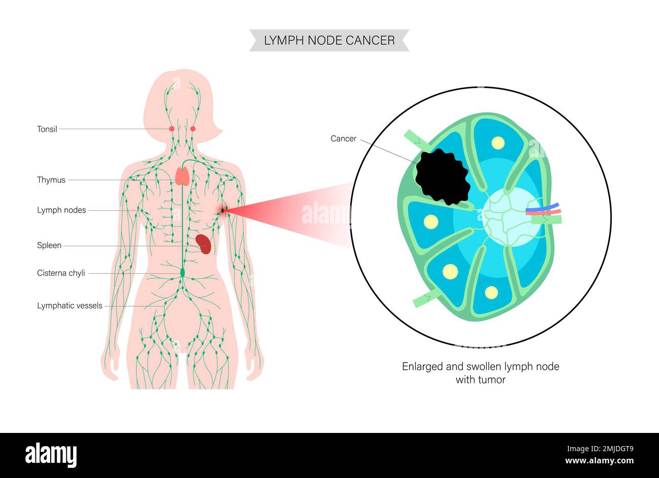 Lymphoma, conceptual illustration Stock Photo - Alamy