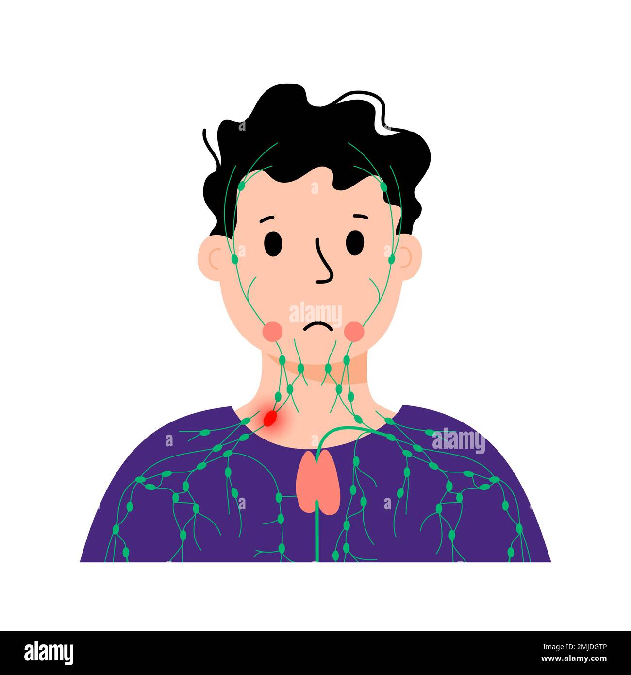 Lymphoma, conceptual illustration Stock Photo - Alamy Lymphoma, conceptual illustration Stock Photo - Alamy
