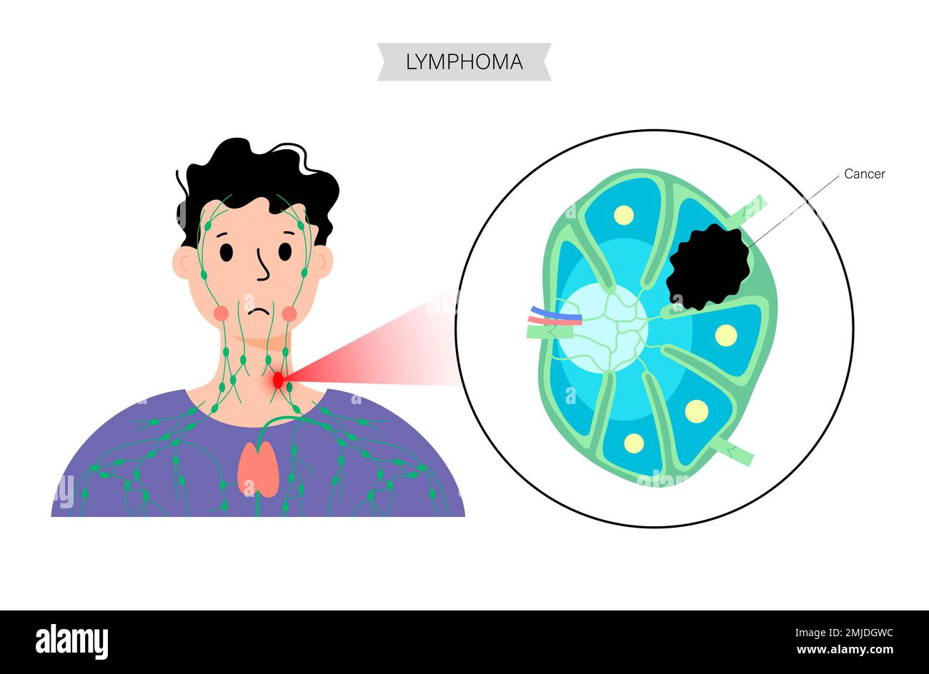 Swollen lymph node hi-res stock photography and images - Alamy