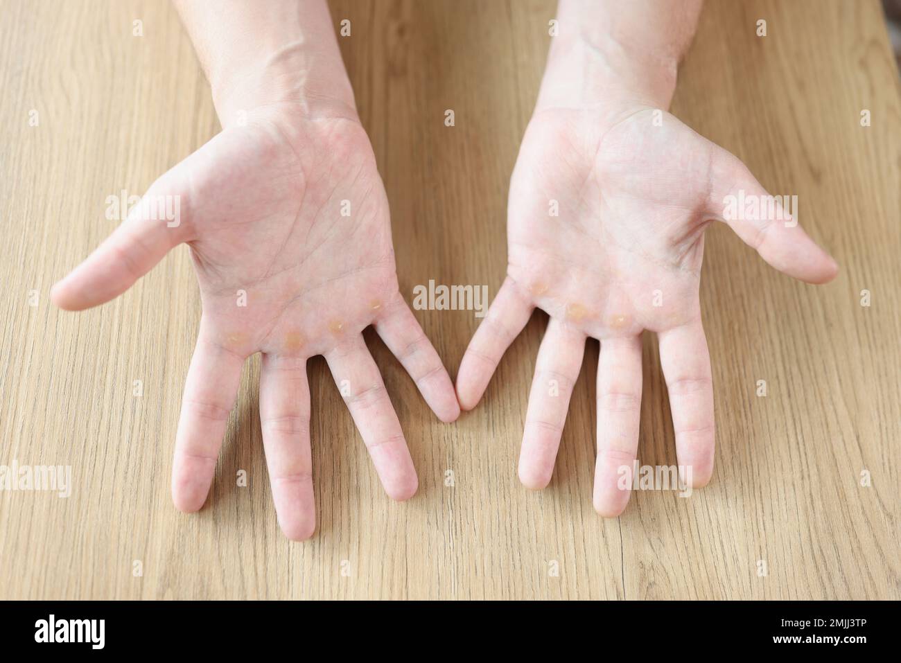 Many calluses on distal palmar surface of hands Stock Photo - Alamy