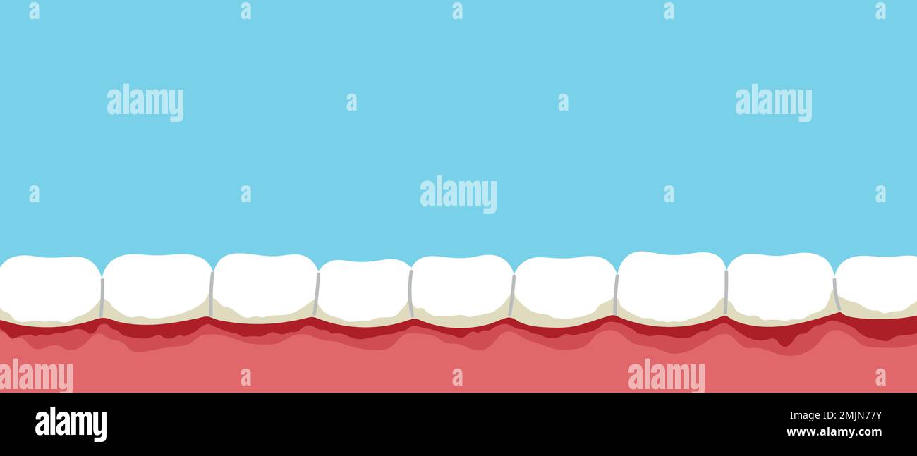 Gum disease cartoon banner. Periodontitis, gum bleeding, plaque on the ...