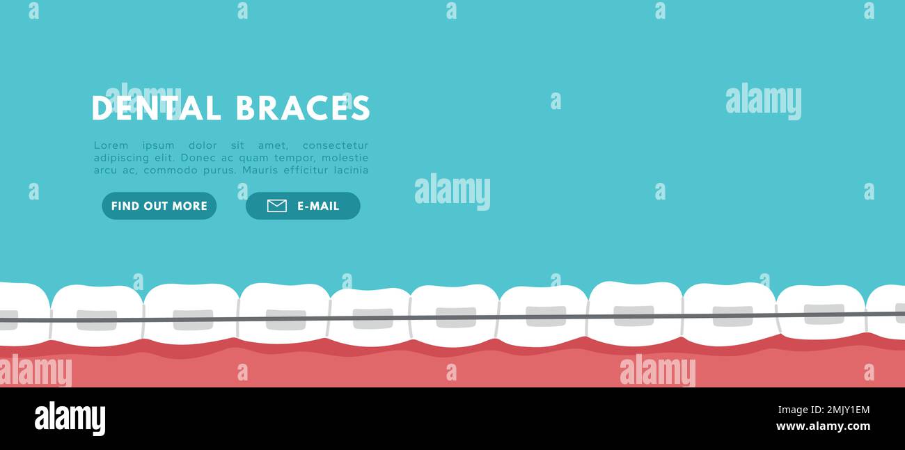 Retainer Designs Like Brace Blue