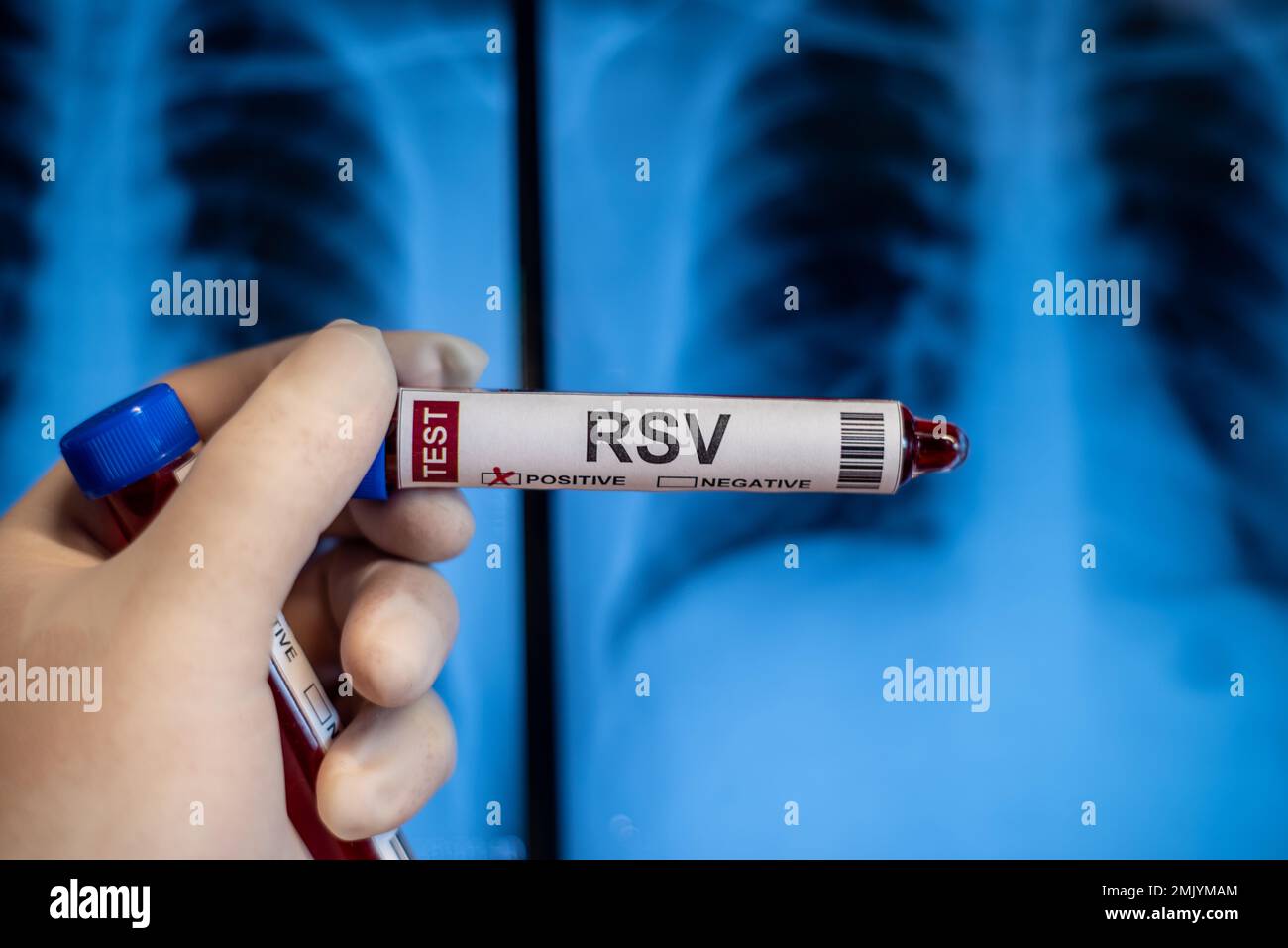 Blood collection tubes Respiratory syncytial virus(RSV) test positive ...