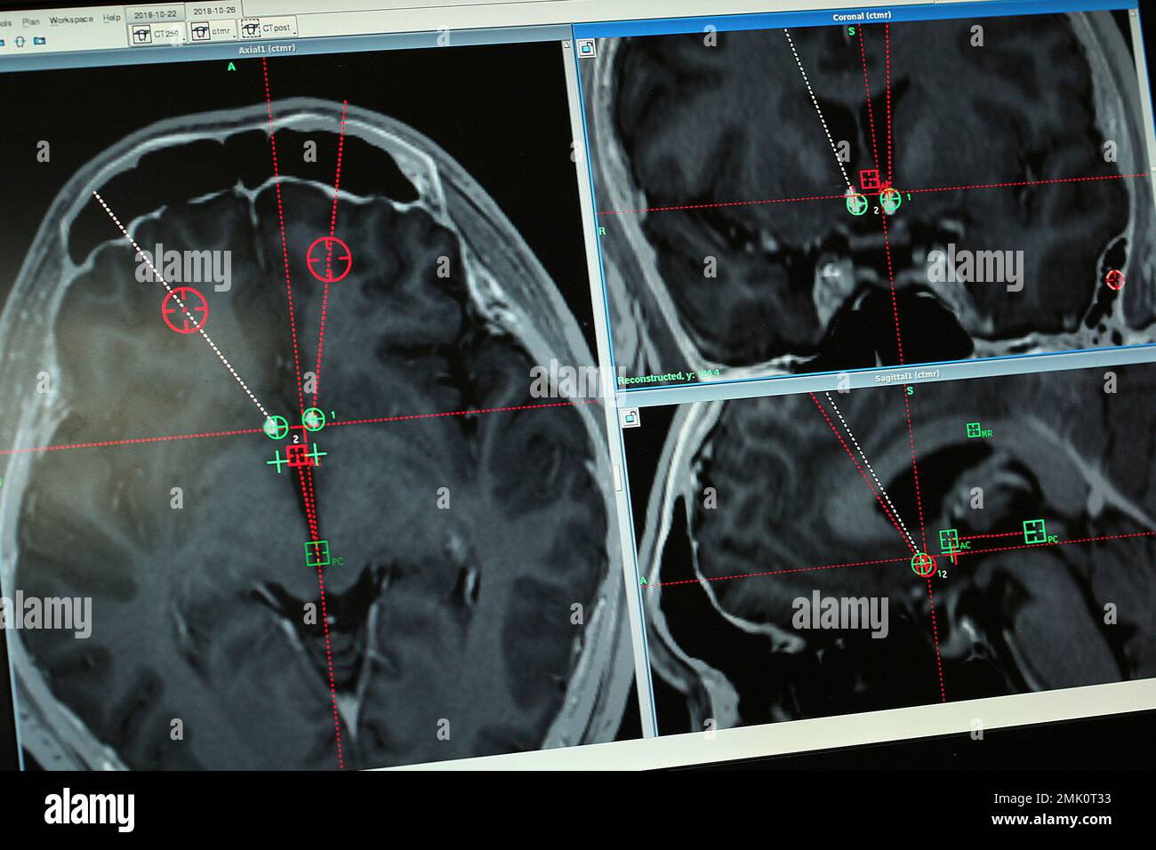 This Monday, Oct. 29, 2018, photo shows a brain scan of a ...