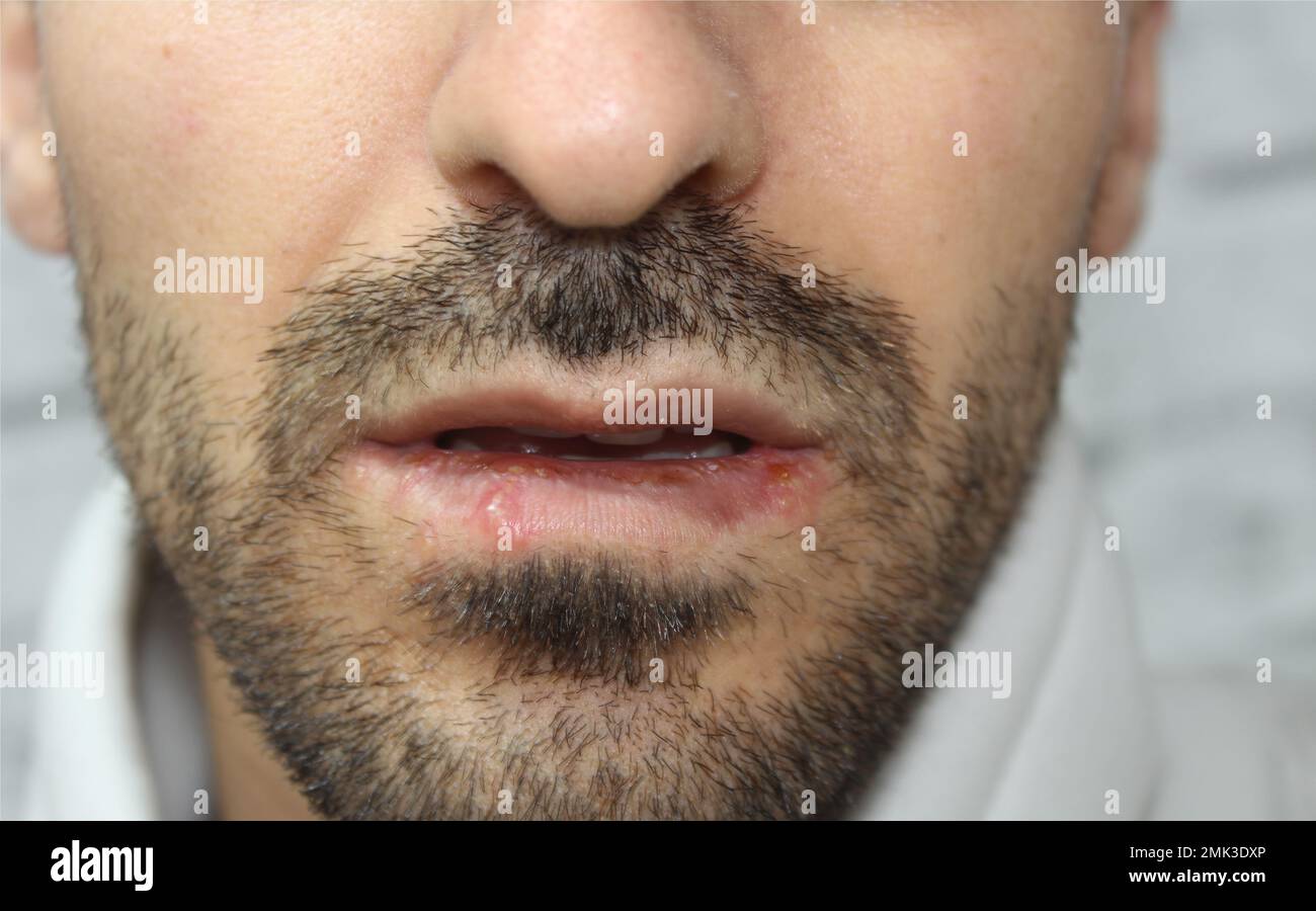 Herpes Infection On The Lips Of A Man Close Up And Selective Focus On Herpes Infection Stock