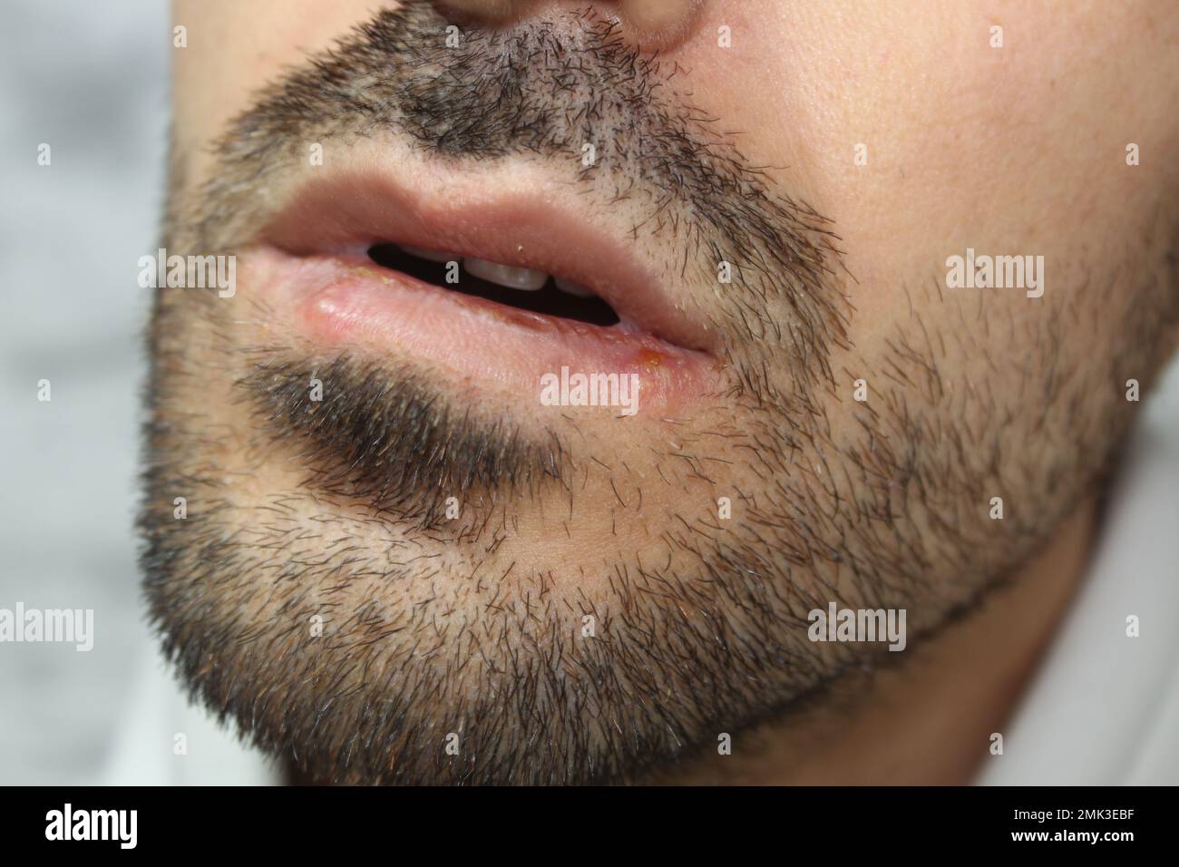 Herpes infection on the lips of a man. Close up and selective focus on ...
