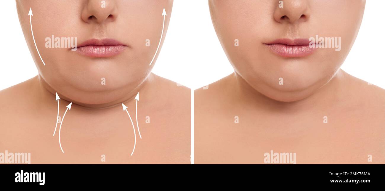 Neck operation hi-res stock photography and images - Alamy