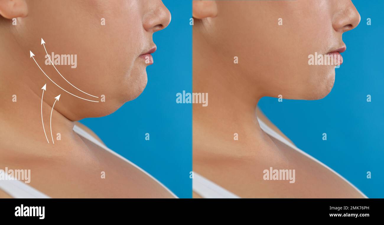 Woman before and after plastic surgery operation on blue background ...