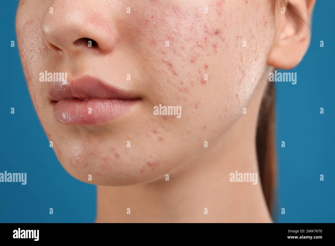 Teenage girl with acne problem on blue background, closeup Stock Photo ...
