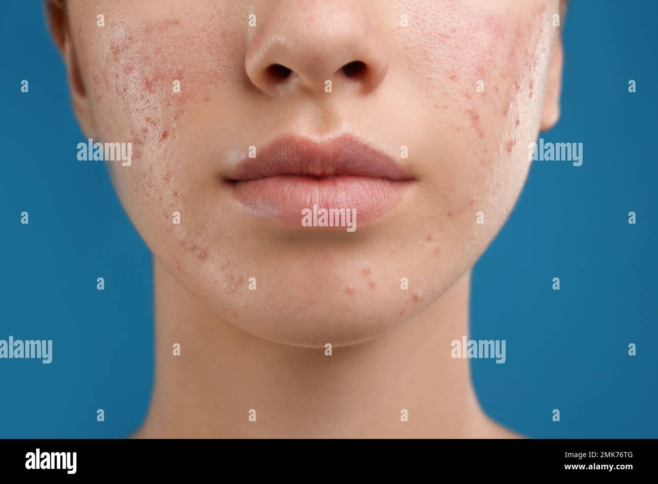 Teenage girl with acne problem on blue background, closeup Stock Photo ...