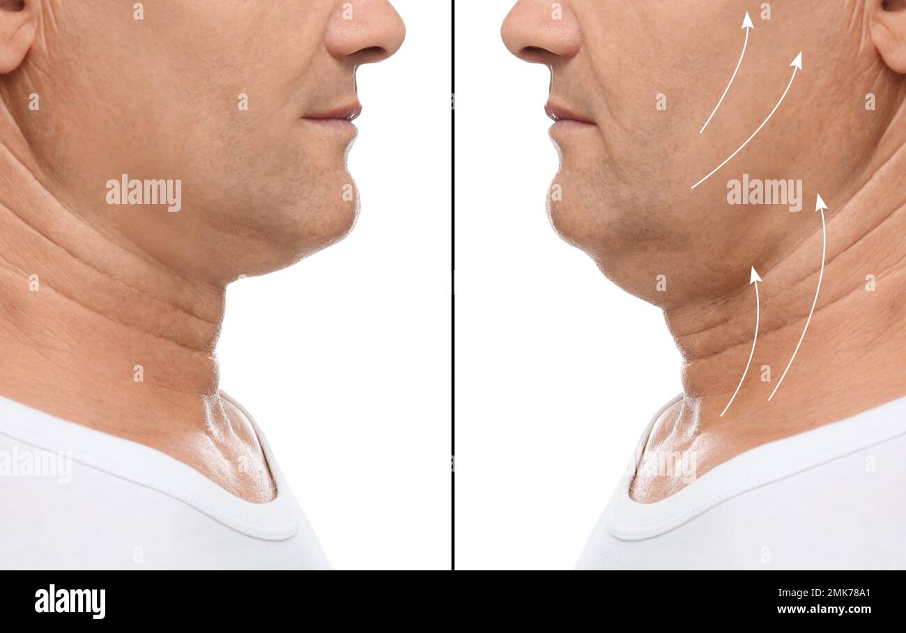 Mature man before and after plastic surgery operation on white ...