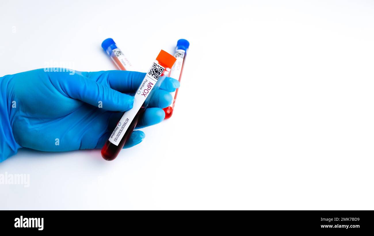 flasks with blood tests for monkey pox virus positive and negative ...