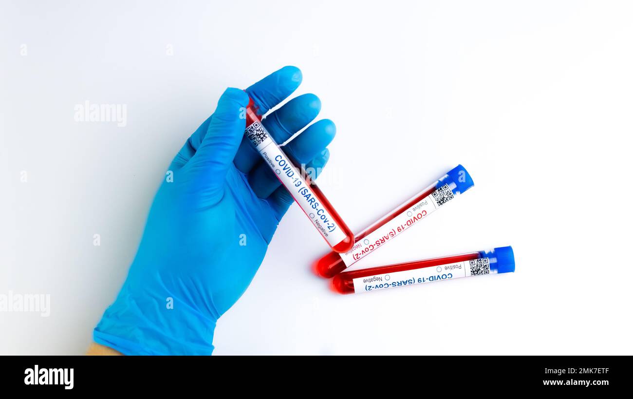 flasks with blood tests for monkey pox virus positive and negative ...