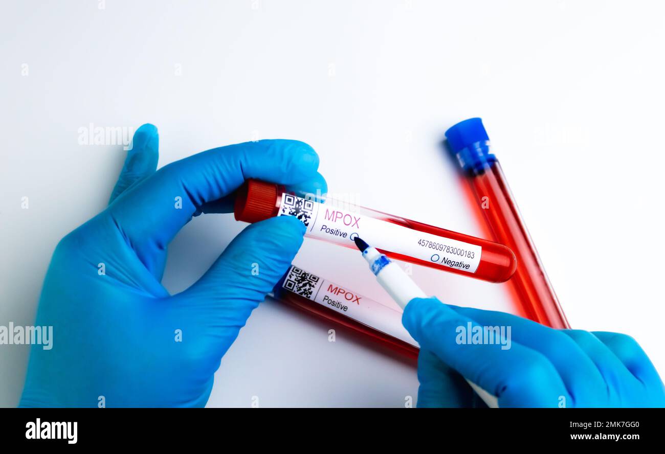 flasks with blood tests for monkey pox virus positive and negative ...