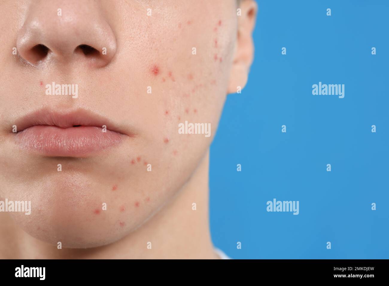 Teen guy with acne problem on blue background, closeup Stock Photo - Alamy