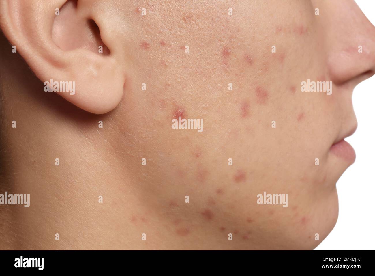 Teen guy with acne problem on white background, closeup Stock Photo - Alamy