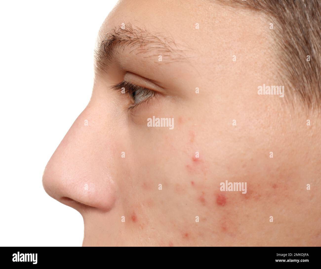 Teen guy with acne problem on white background, closeup Stock Photo - Alamy