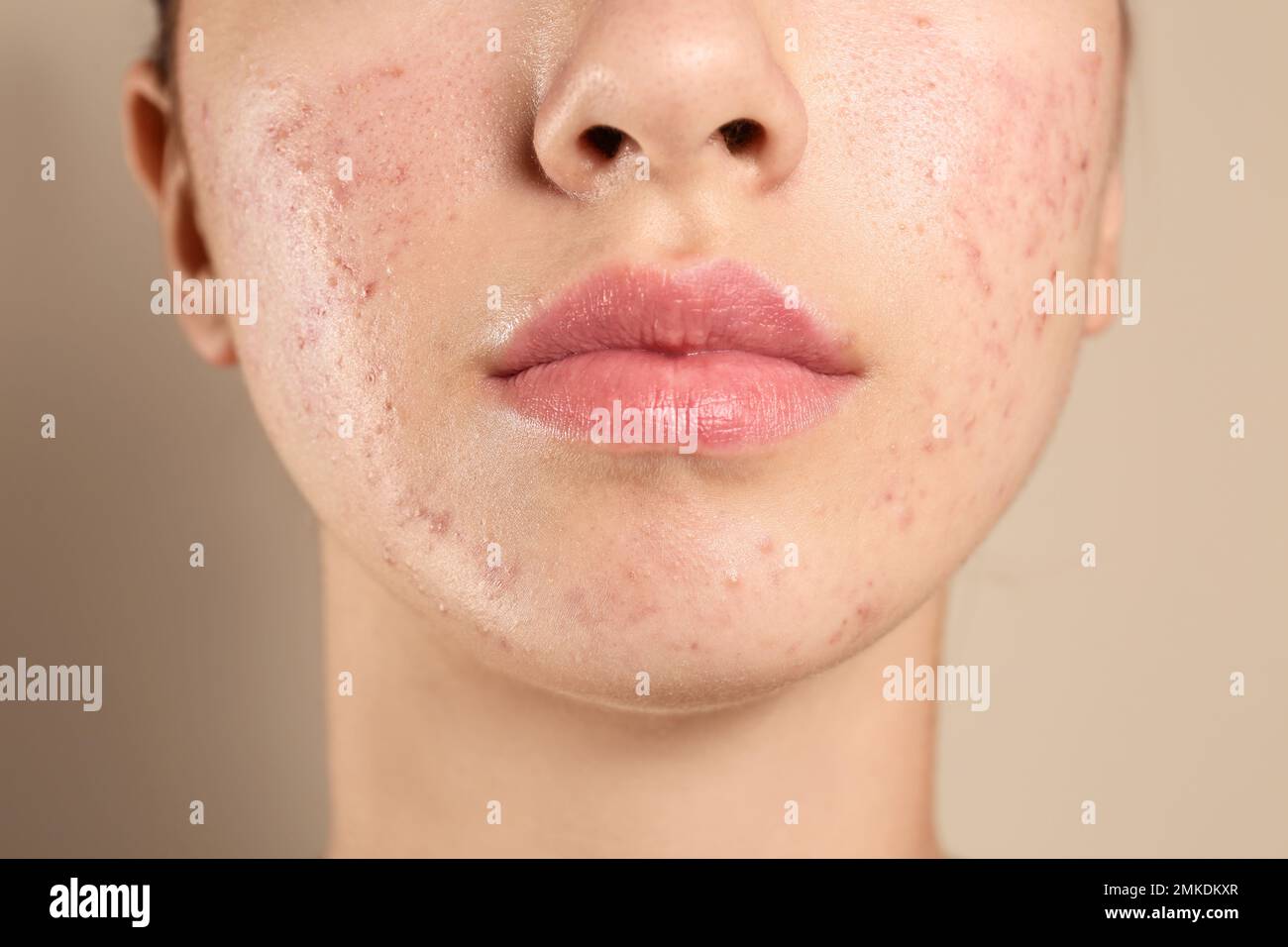 Teenage girl with acne problem on beige background, closeup Stock Photo ...