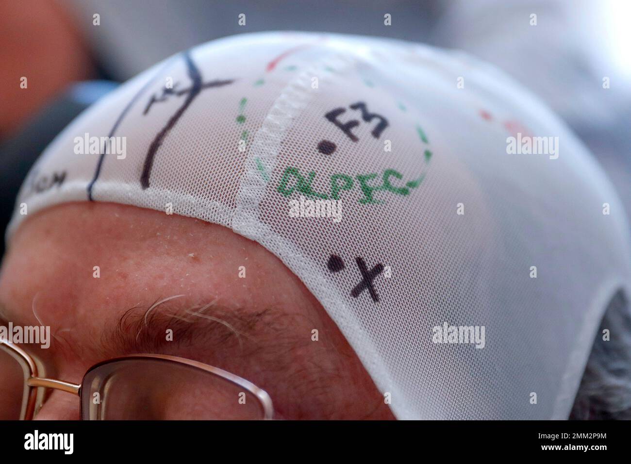 A patient's head cap is marked to pinpoint an area of the brain to use ...