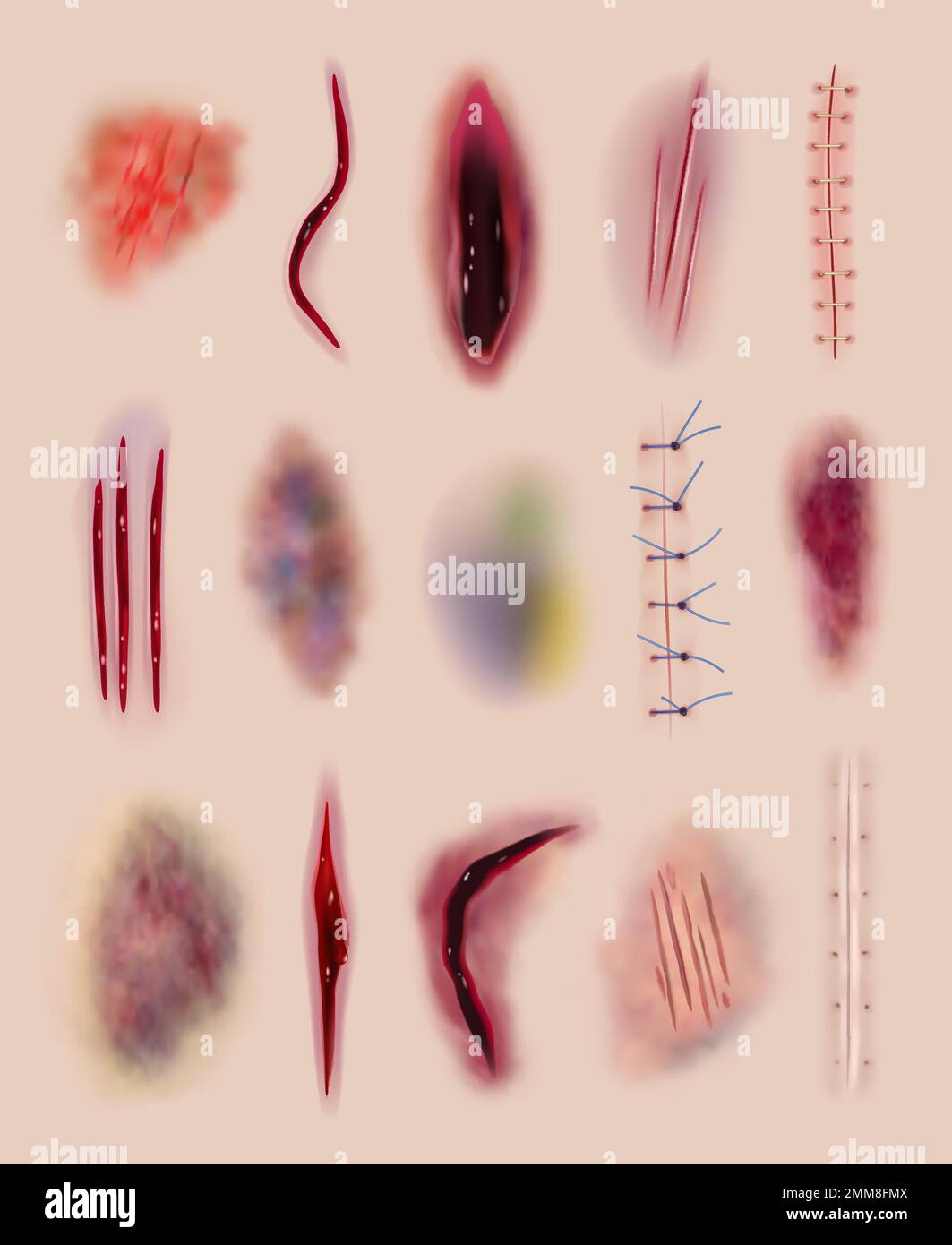 Bloody stitching. Cuts and wounds scars decent vector horror stiches in realistic style medicine ...