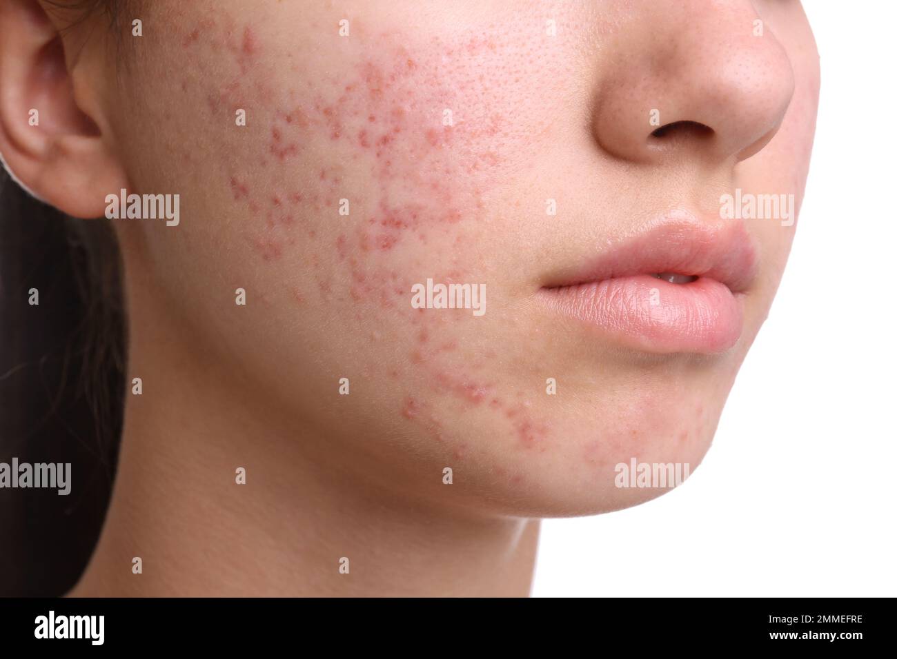 Teenage girl with acne problem on white background, closeup Stock Photo ...