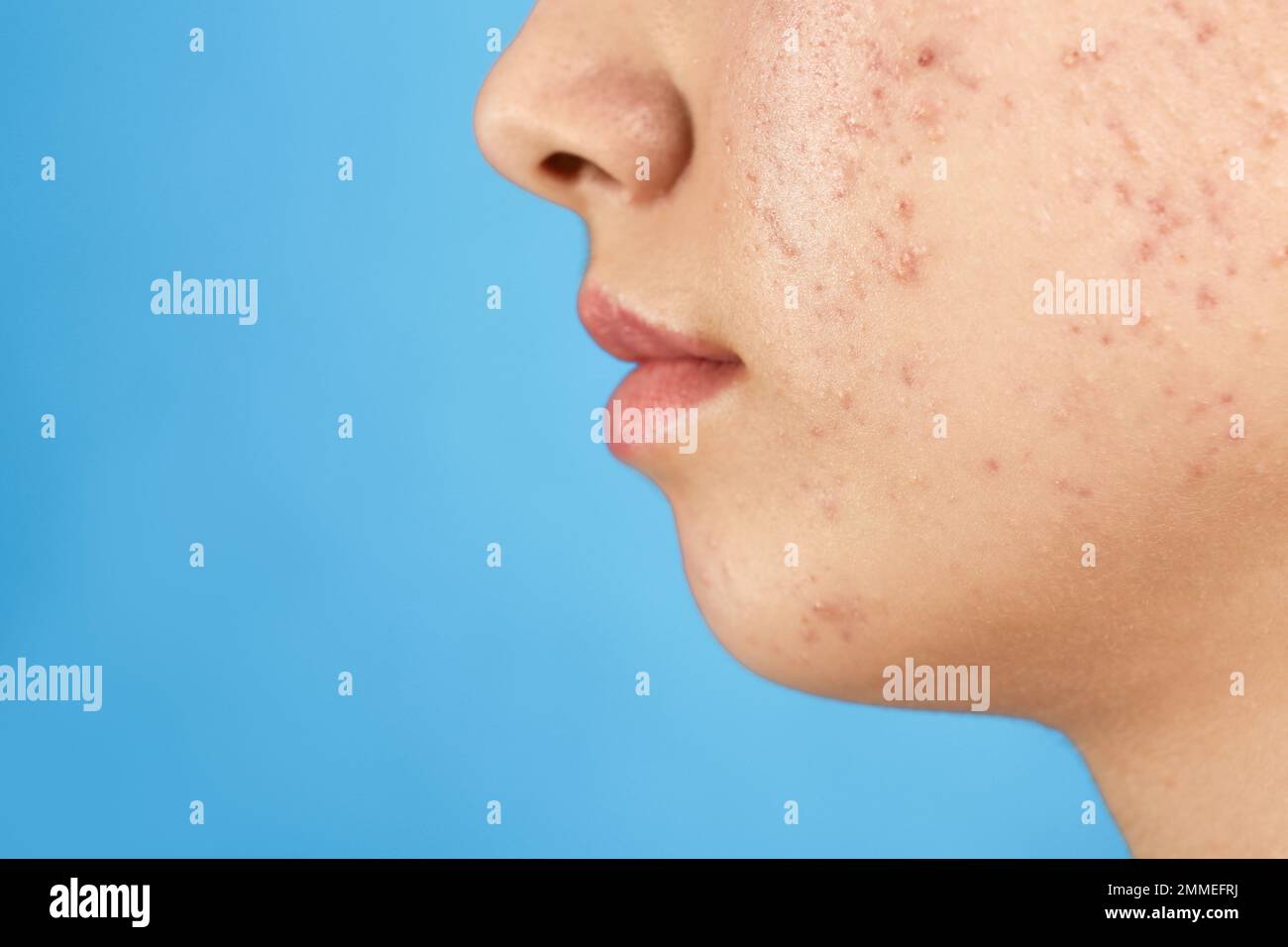 Teenage girl with acne problem on blue background, closeup Stock Photo ...