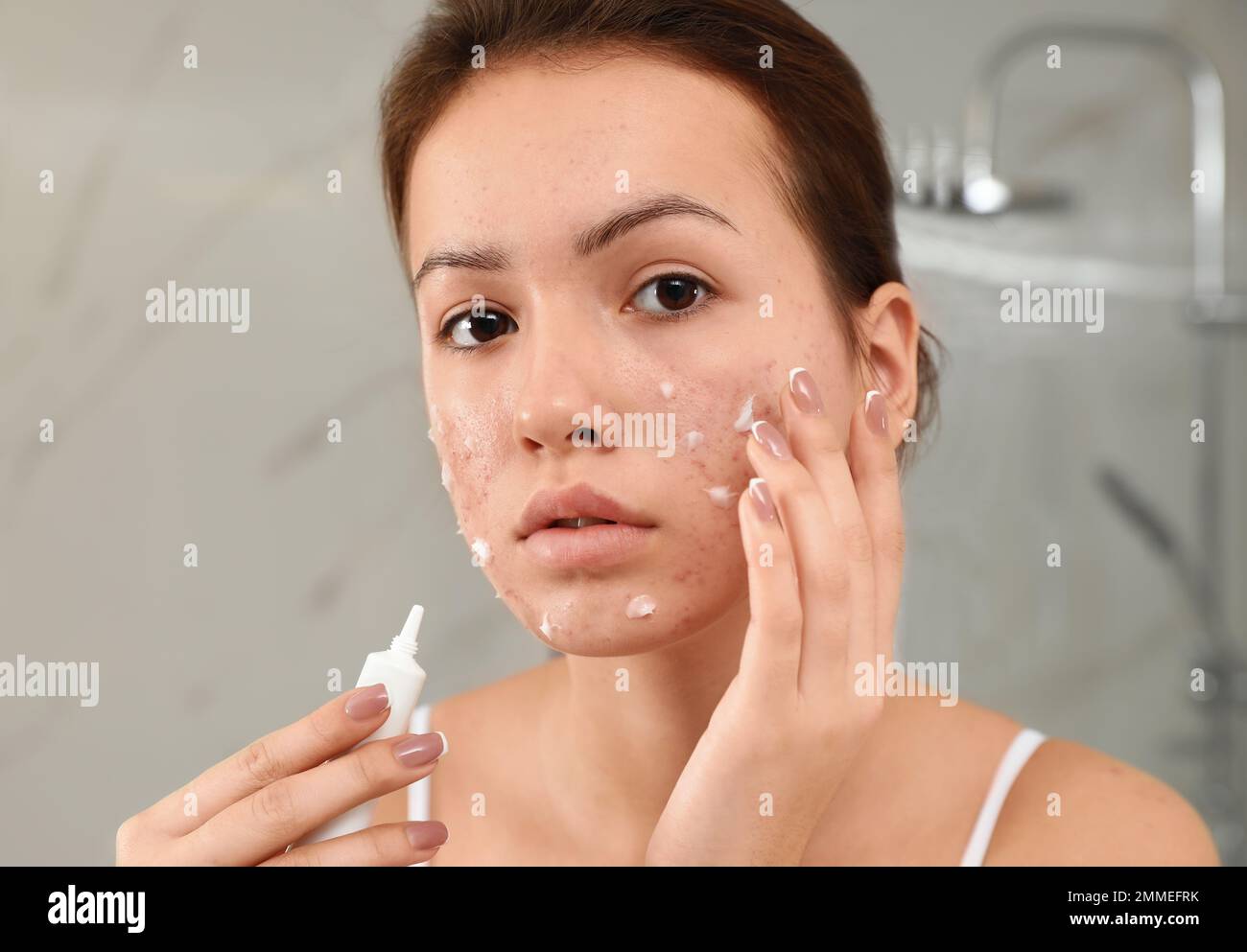 Teen girl with acne problem applying cream in bathroom Stock Photo - Alamy