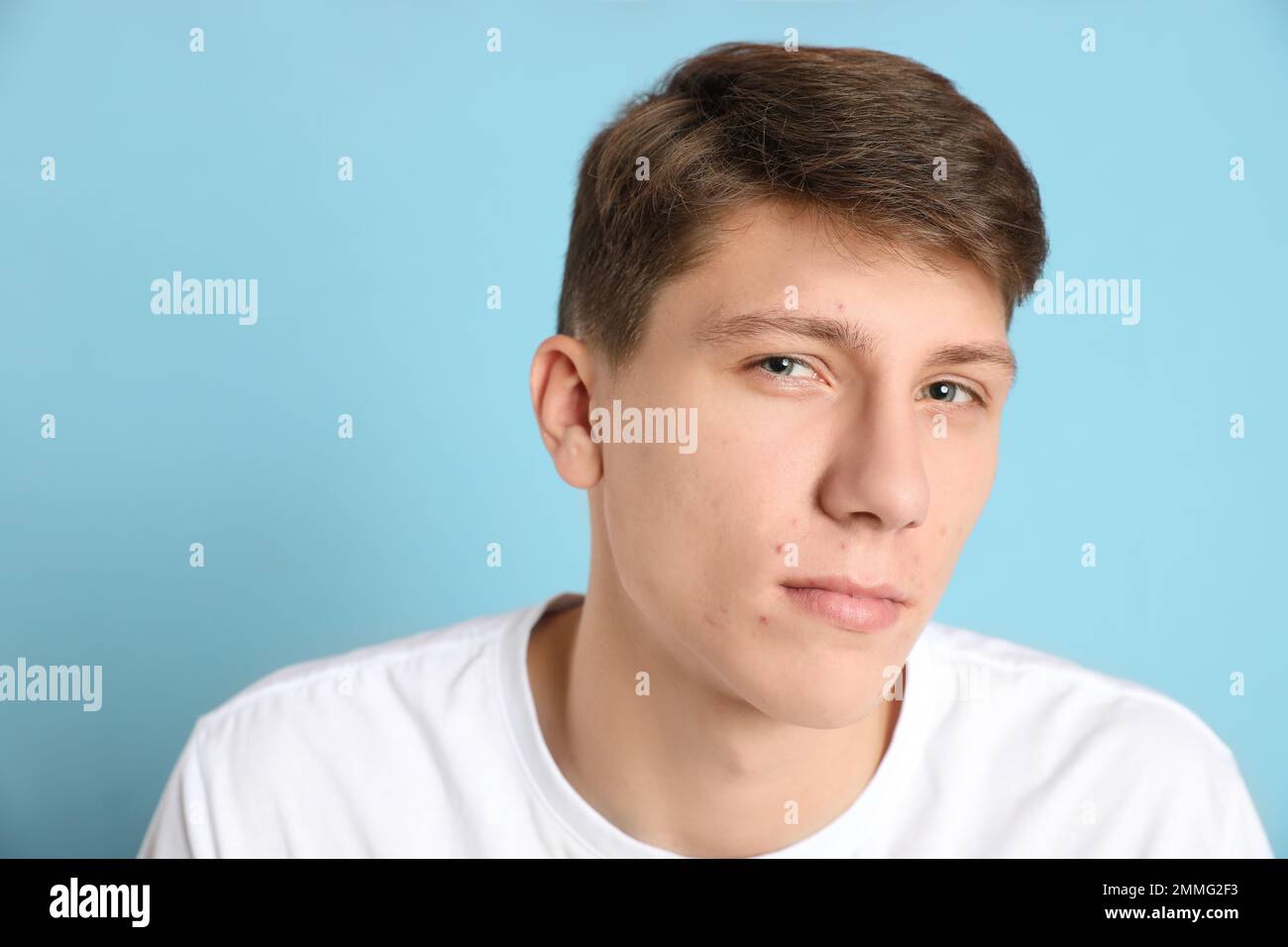 Teen guy with acne problem on light blue background Stock Photo - Alamy