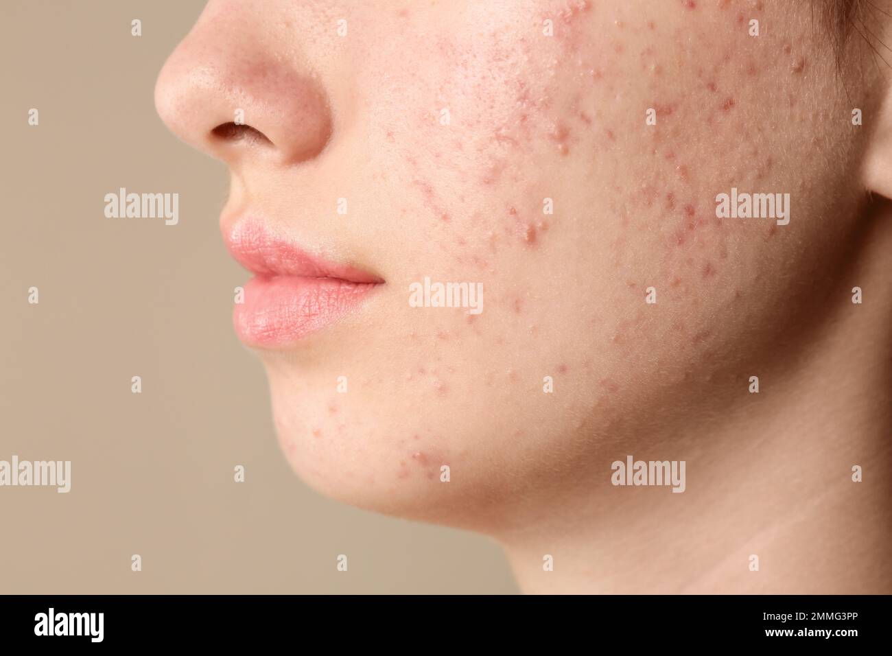 Teenage girl with acne problem on beige background, closeup Stock Photo ...