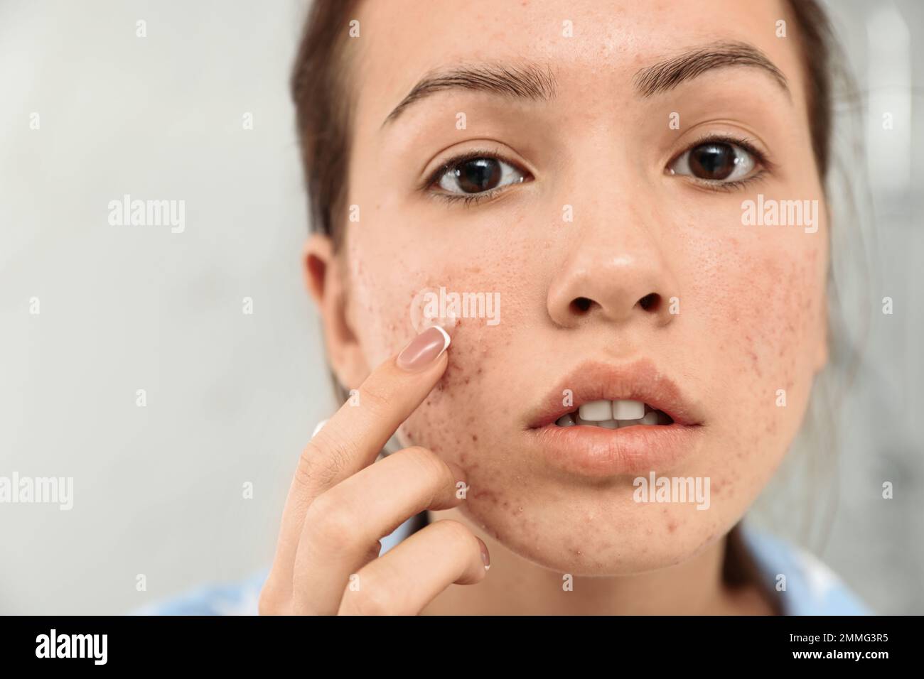 Acne patch hi-res stock photography and images - Alamy