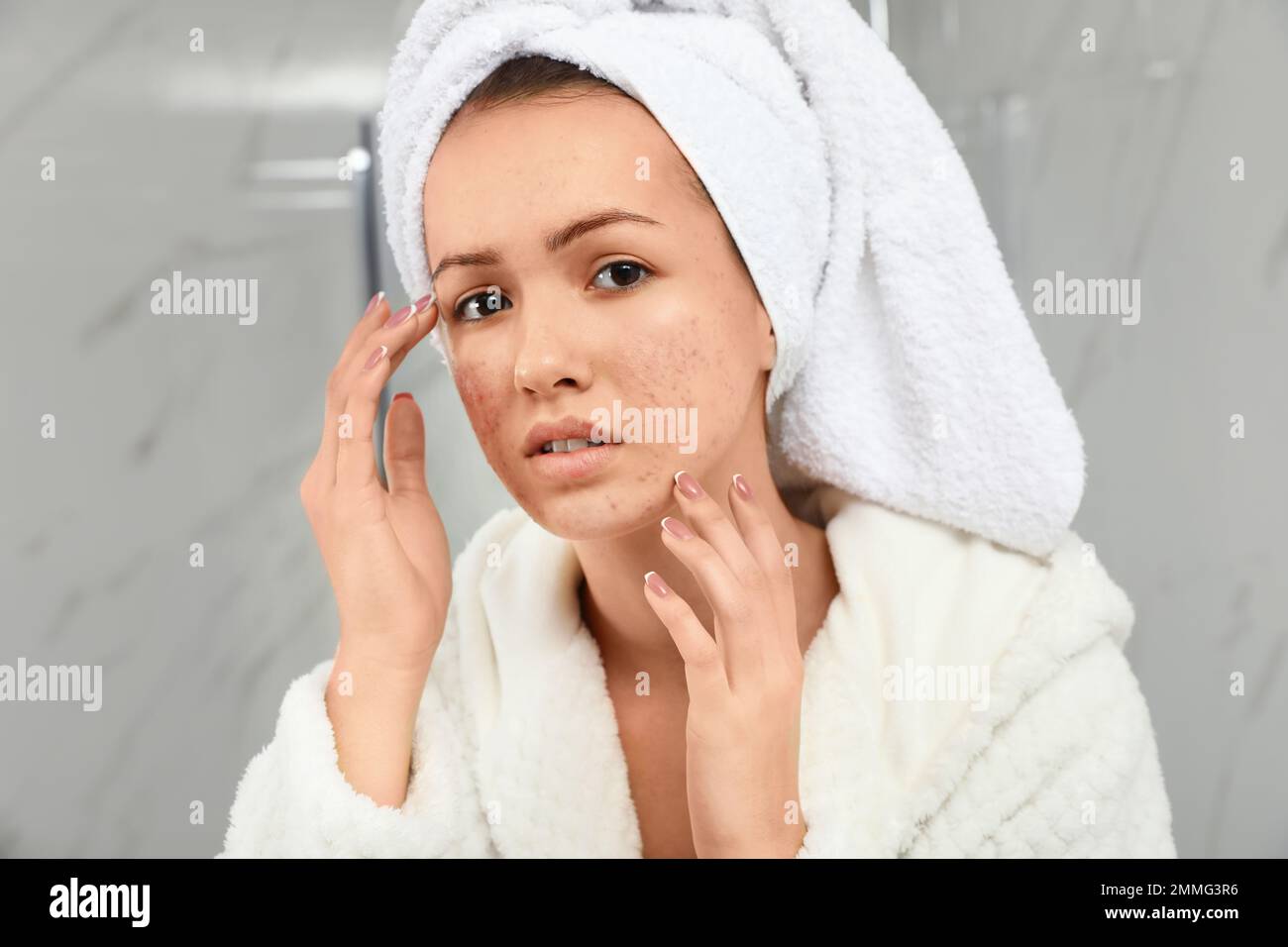 Woman skin teenager problem hi-res stock photography and images - Alamy