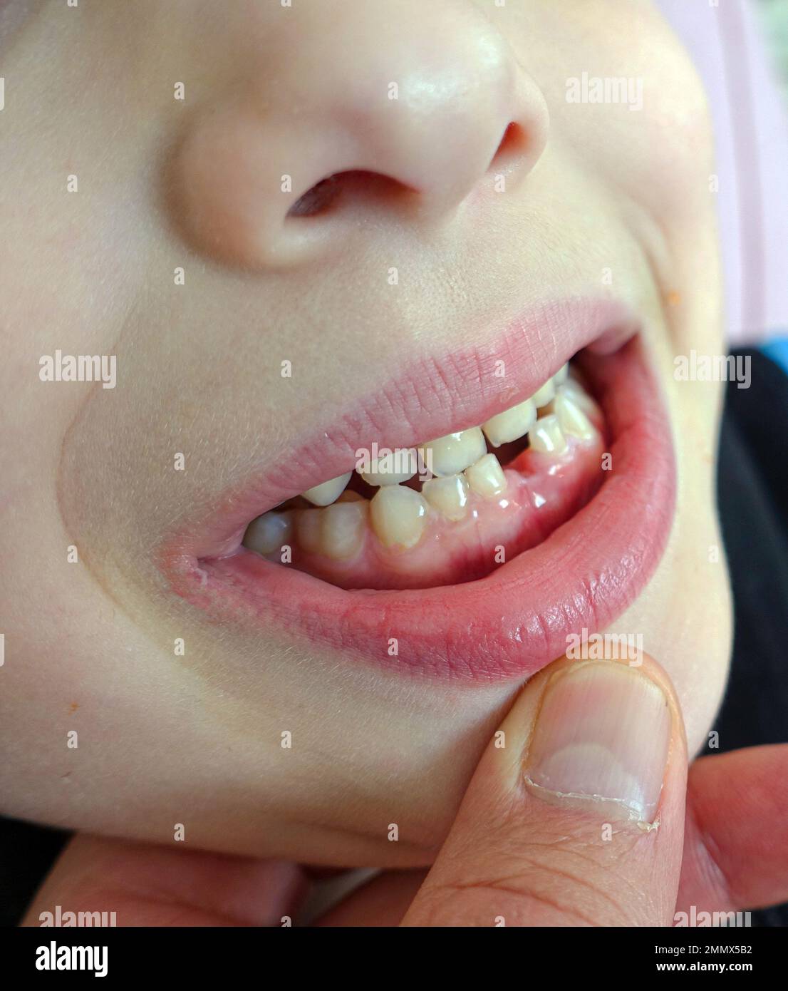 close-up a child who lost a baby tooth ,A child who lost a baby tooth ...