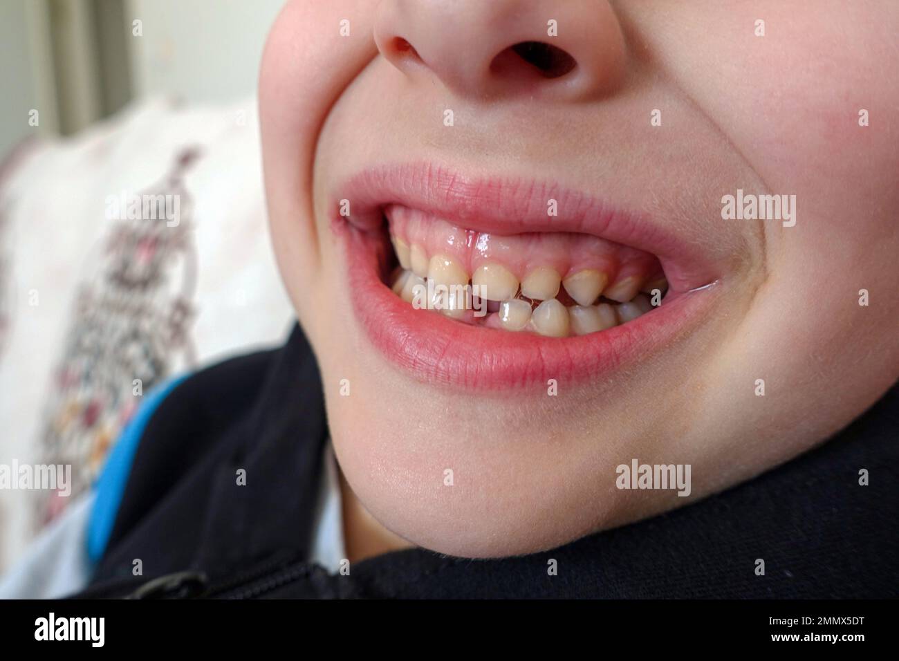 close-up a child who lost a baby tooth Stock Photo - Alamy