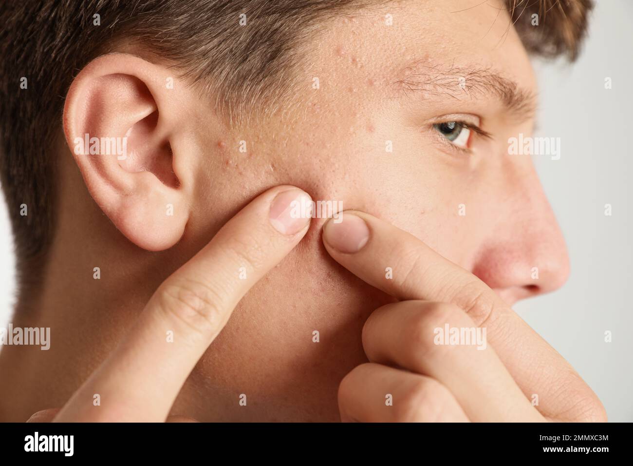 Teen guy with acne problem squeezing pimple on his face on light ...