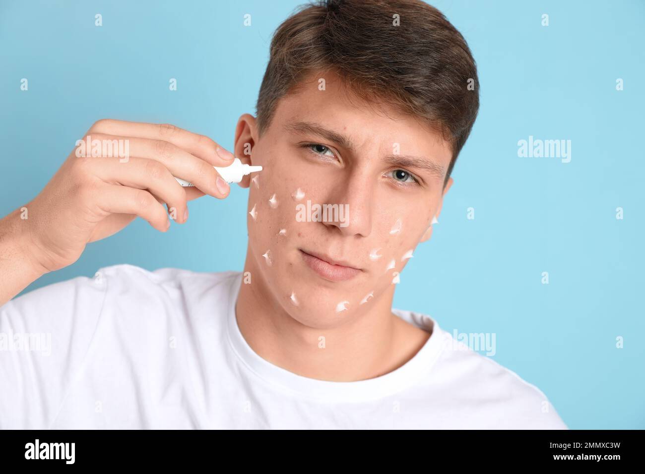 Teen guy with acne problem applying cream on light blue background ...