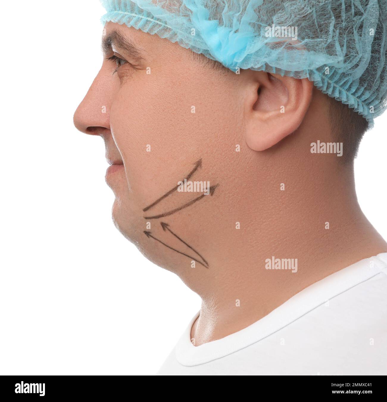 Mature man with marks on face against white background, closeup. Double ...