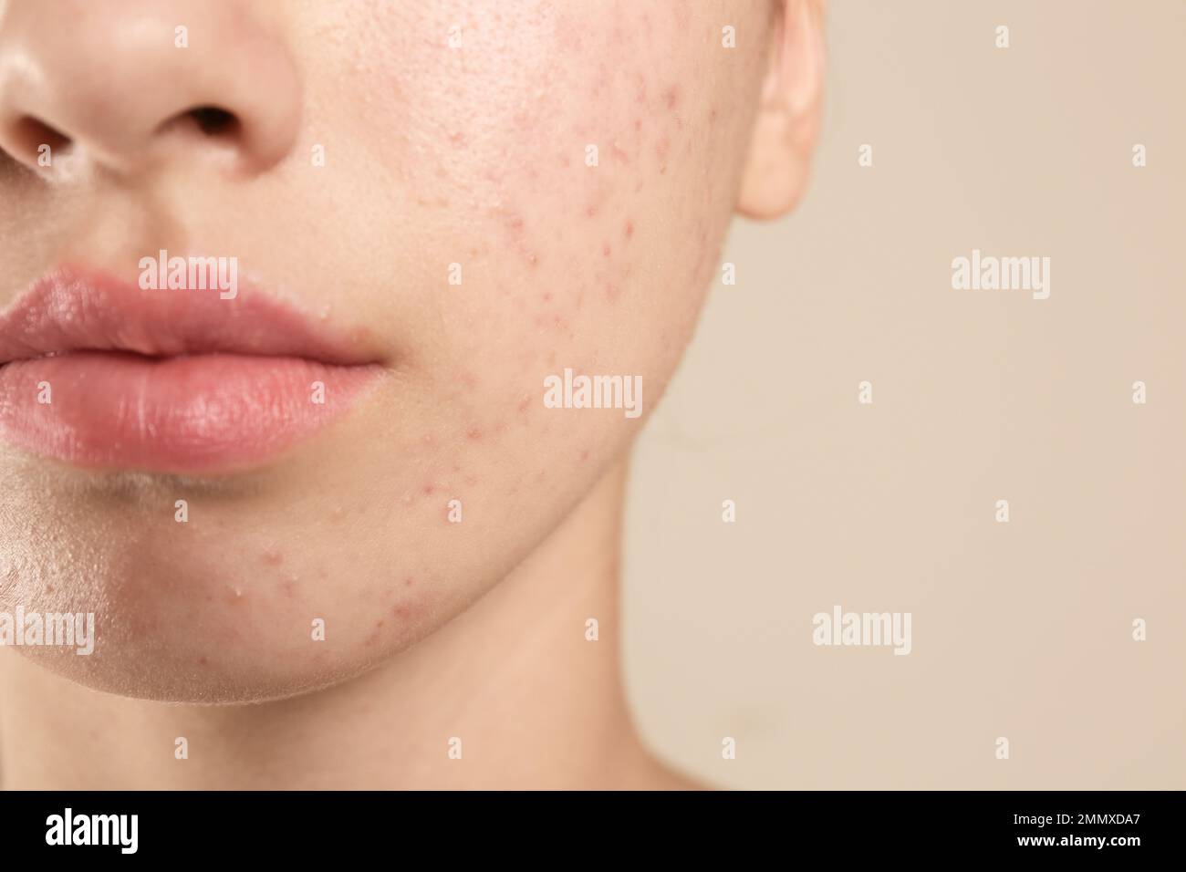 Teenage girl with acne problem on beige background, closeup Stock Photo ...
