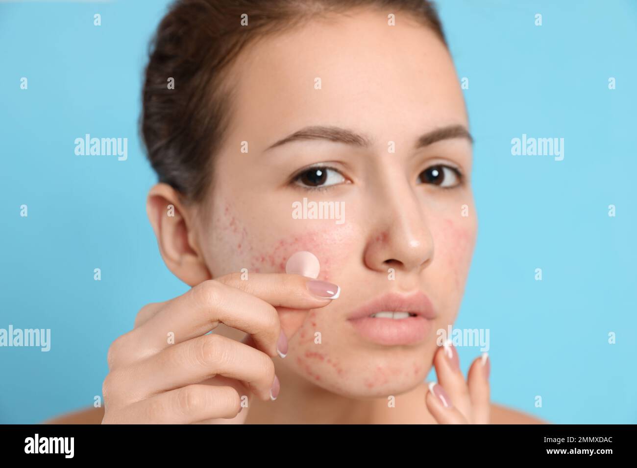 Teen girl applying acne healing patch on light blue background Stock ...